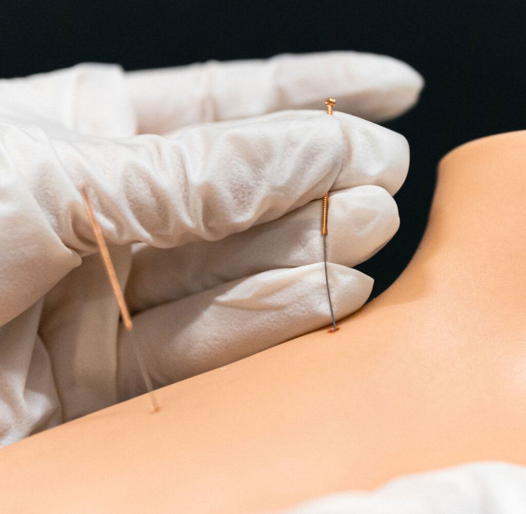 Acupuncture and Acupressure: Ancient Healing Arts for Modern Wellness ...