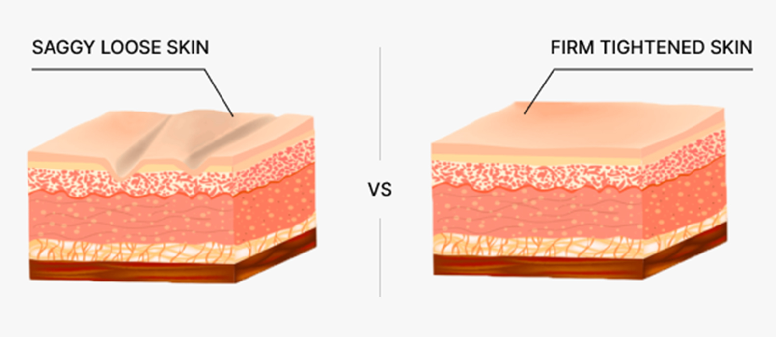 Is It Possible to Reduce Cellulite & Stretch Marks? The Latest Research ...
